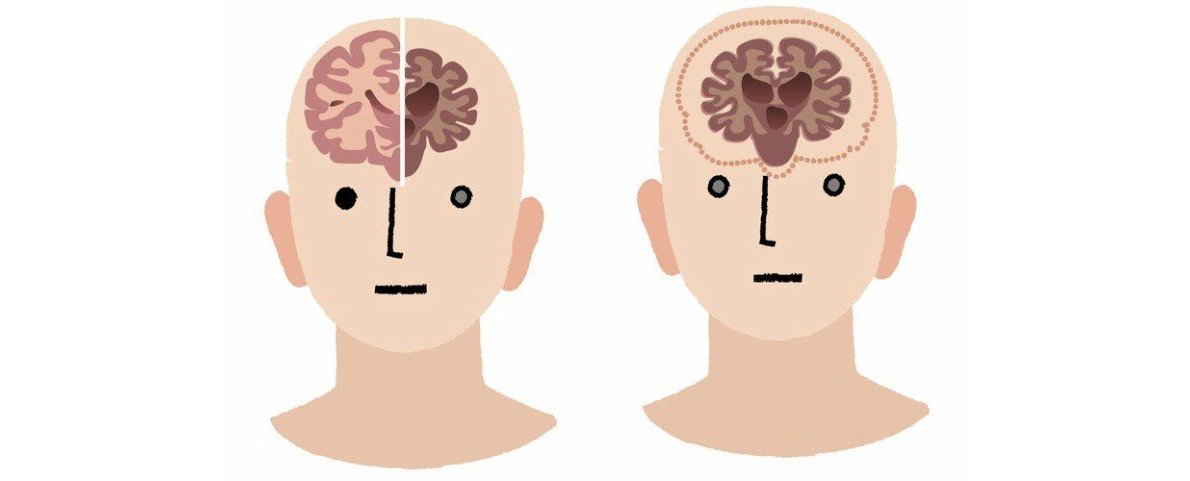 7 Subtle Signs of Dementia